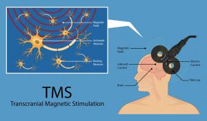 TMS Therapy – Rewire